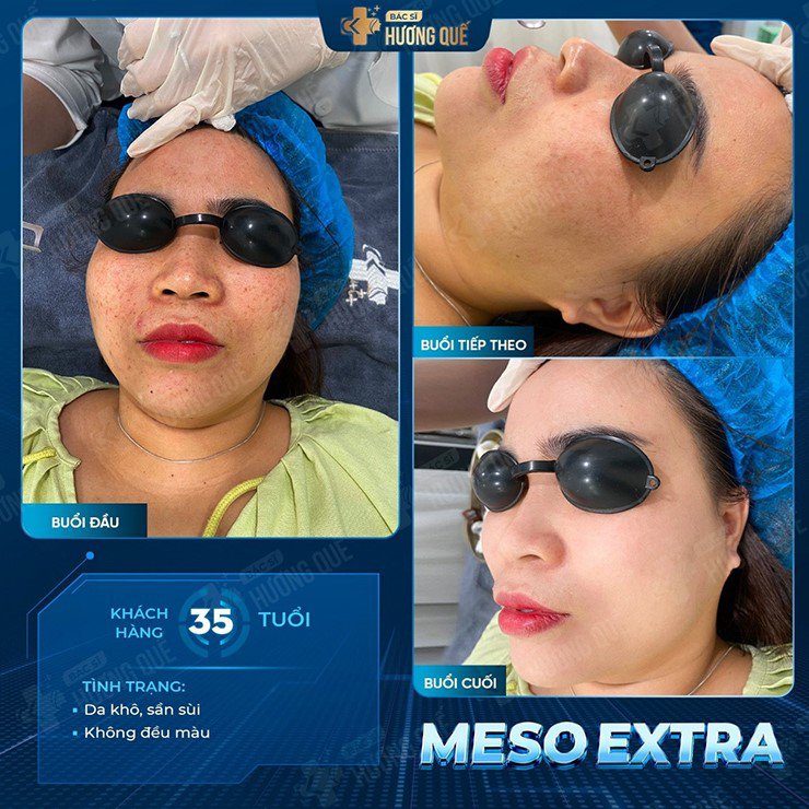 Những lợi ích không tưởng của Meso Extra đối với làn da - chia sẻ từ bác sĩ Hương Quế