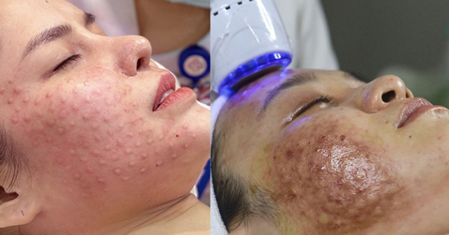 Sự khác biệt giữa Meso thông thường và Meso Extra kết hợp với máy Bellasonic 2x